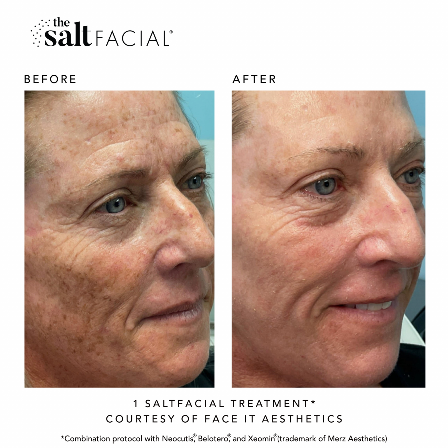 Salt Facial® Arlington - Fort Worth TX - Accent On You